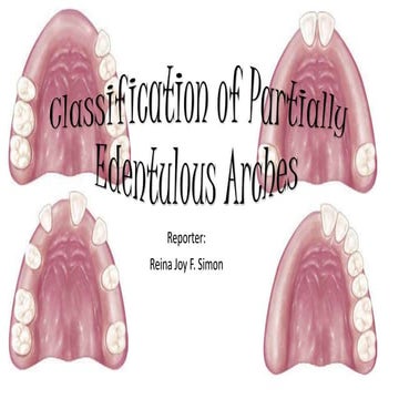 Classification of Partially Edentulous Teeth | PPTX