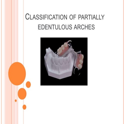 Kennedy’s Classification in Cast Partial Denture | PPTX