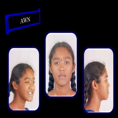 Orthodontic Case Report - Class III | PPTX | Dental Health | Diseases ...