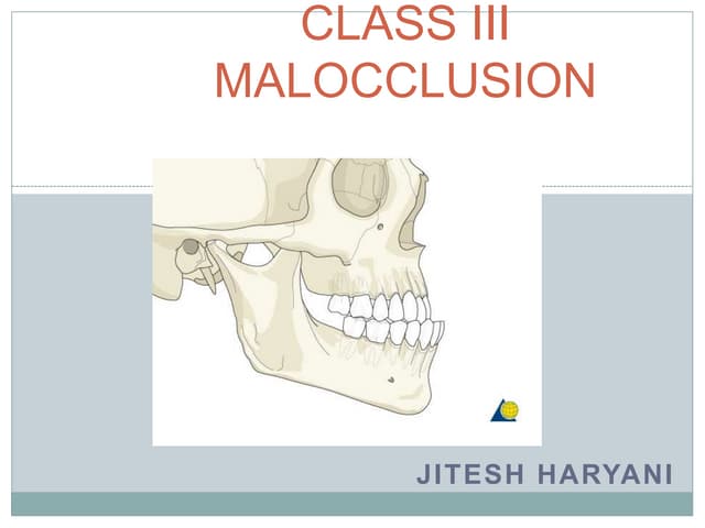 Class III Malocclusion | PPTX