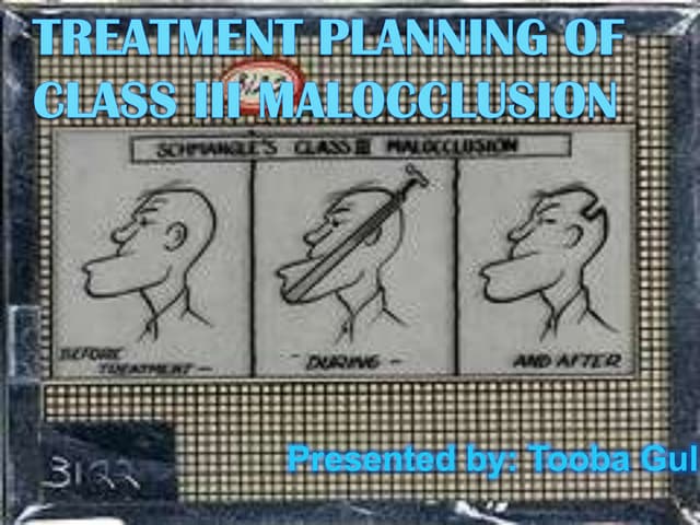 Class III Malocclusion | PPTX