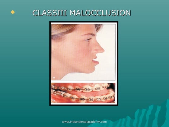 Class III Malocclusion | PPTX