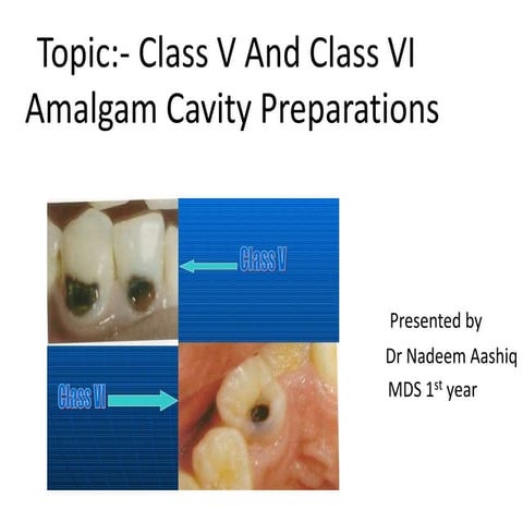 Class iii cavity preparation | PPTX