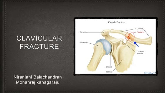 Upper limb trauma ( clavicle & shoulder fracture) | PPT