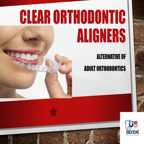 Clear Orthodontic Aligners | PPT