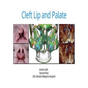 Management of Cleft Lip and Palate - Orthodontics | PPTX