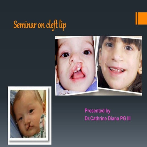 Cleft lip | PPTX