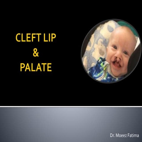 cleft lip and cleft palate.pptx