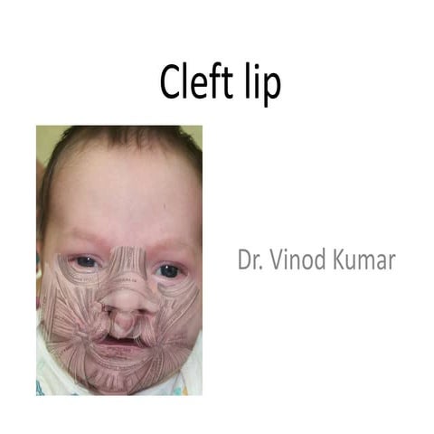 cleft lip.pptx