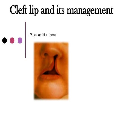 cleft lip and palate and its management.pptx
