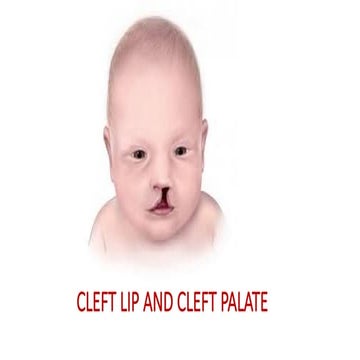 CLEFT LIP AND CLEFT PALATE BY AGNES .pptx