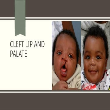 Anesthetic Management for Cleft Lip & Palate | PPTX