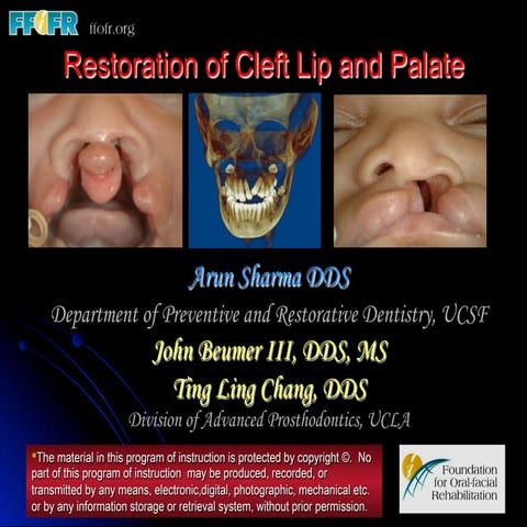 Cleft lip and palate | PDF