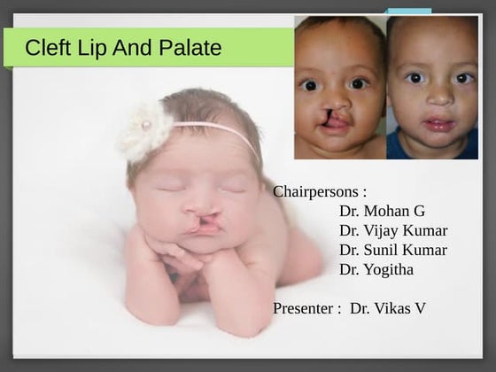 Bells palsy | PPT