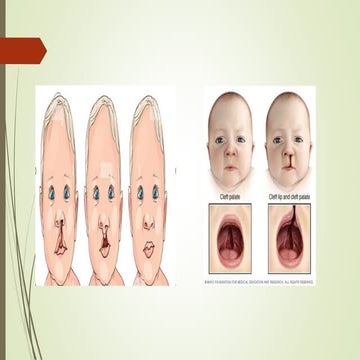 cleft lip and palate1.pptx