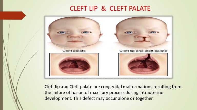 Cleft lip and cleft palate