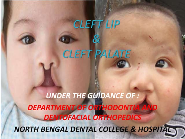 Cleft lip & palate