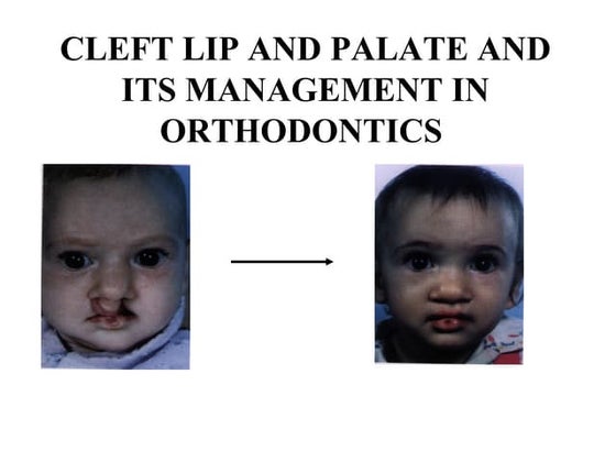cleft-lip-palate | PPT