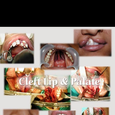seminar on cleft lip and cleft palate.pptx