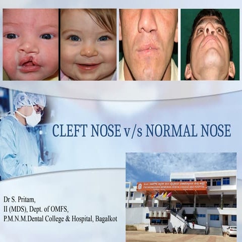 CLEFT NOSE CLEFT NOSE RHINOPLASTY v.pptx | Ear, Nose and Throat Conditions | Diseases and Conditions