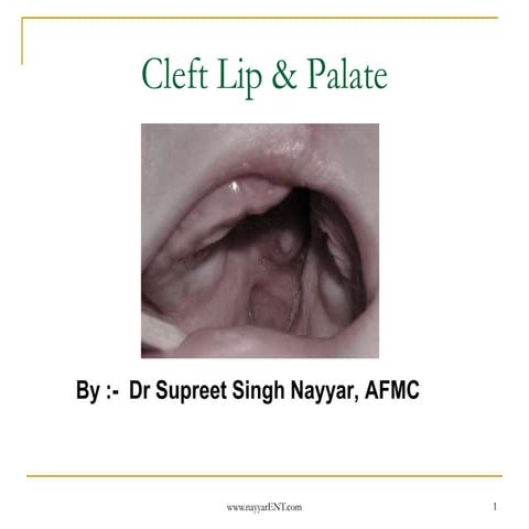 Cleft Palate Lip Bifid uvula submucosal cleft modified by Dr Nayyar.ppt | Ear, Nose and Throat ...