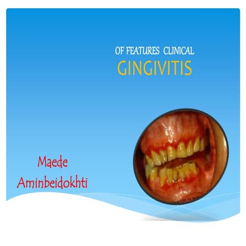 Clinical features of gingivitis | PPTX