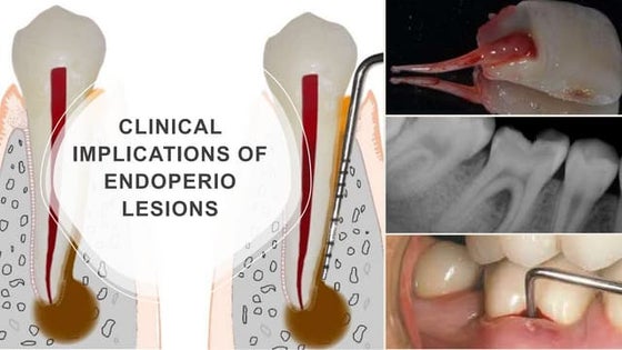 Endo-Perio Lesions | PPTX
