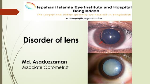Clinical classification of cataracts : Mehedi , Jr. Optometrist | PPTX