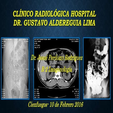 Linfoma del tracto gastroIntestinal Clínico radiológica | PPTX