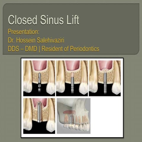 Closed Sinus Lift Surgery | PPTX