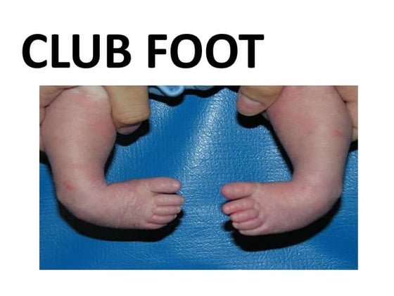 Club foot | PPT