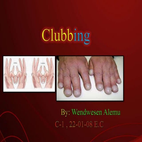 Clubbing | PPTX