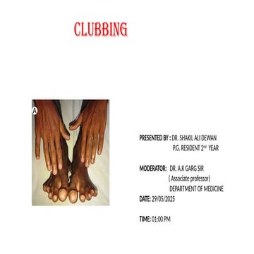 CLUBBING.pptx by Dr. Shakil Ali Dewan. smmhmc | PPTX