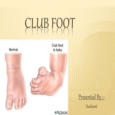 Club foot | PPTX