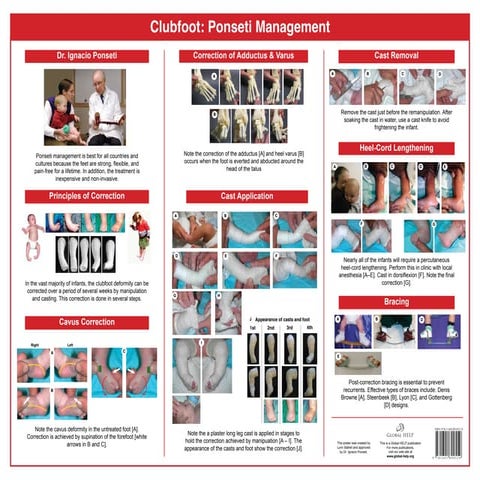 Clubfoot ponseti management (poster) | PDF