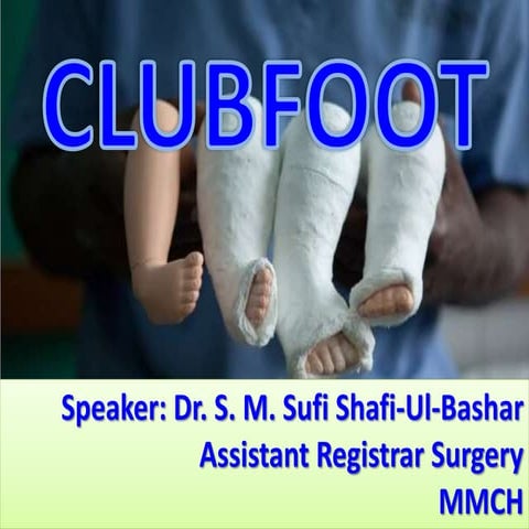 Club foot | PPTX