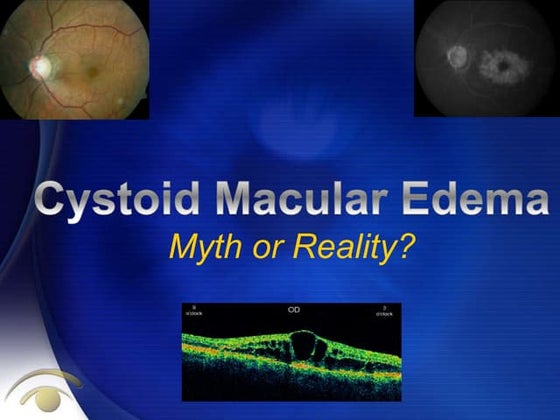 Diabetic macular edema | PPTX | Eye and Vision Conditions | Diseases ...