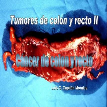 CáNcer De Colon Medicina 2009 | PPT