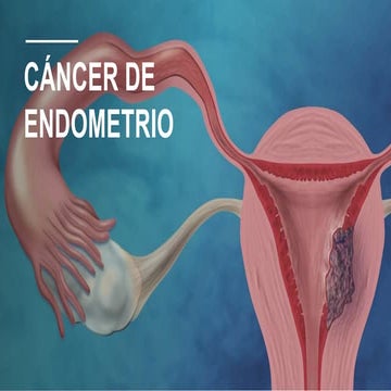 CÁNCER DE ENDOMETrio.pptx