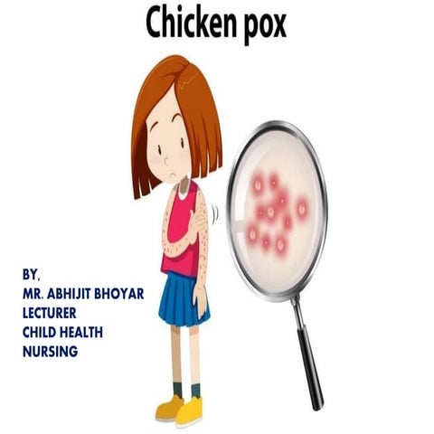Chickenpox | PPTX