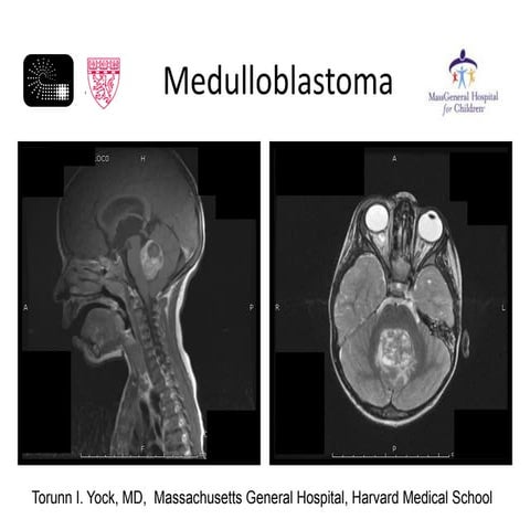 Medulloblastoma - staging, workup and management | PPT
