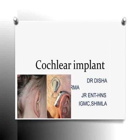 cochlearimplant1-170719132048.pptx