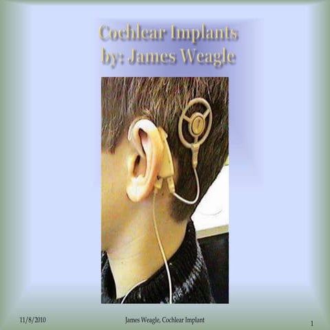 Cochlear implants | PPTX