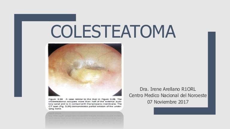 Colesteatoma