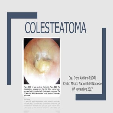 Colesteatoma | PPTX