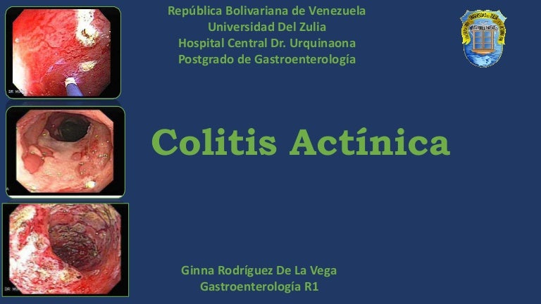 Colitis actínica ginna 1.