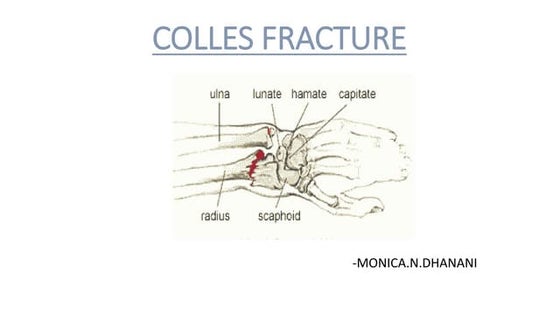 Distal End Radius Fractures - Colles, Smiths & Bartons | PPTX