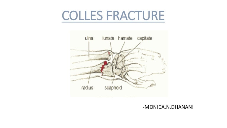 Colles fracture