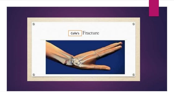 Distal End Radius Fractures - Colles, Smiths & Bartons | PPTX