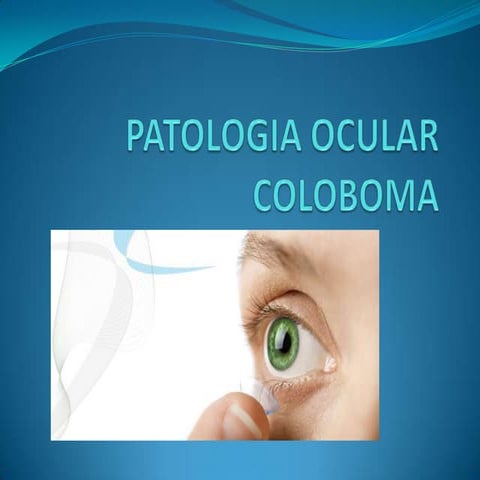 Coloboma congenito y desarrollo embriologico del ojo | PPTX